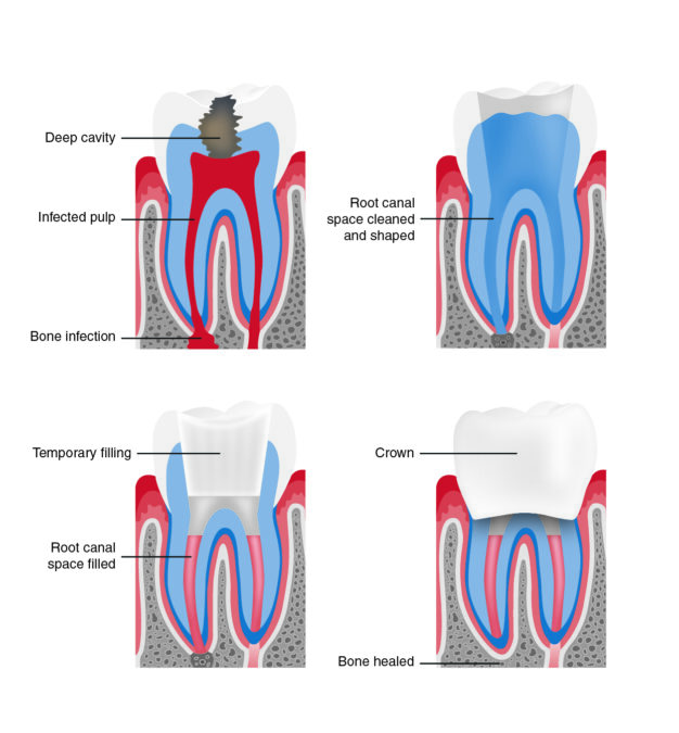 Root Canal Treatment - Holistic Approach | Sydney Holistic Dental Centre