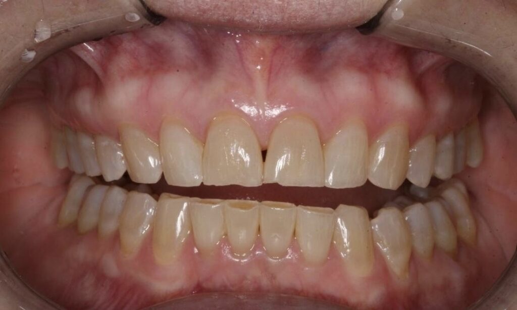 Teeth Grinding at Night and Taping Your Mouth